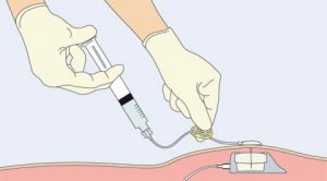[Patientenerfahrung] Was macht der Port bei einer Chemo?